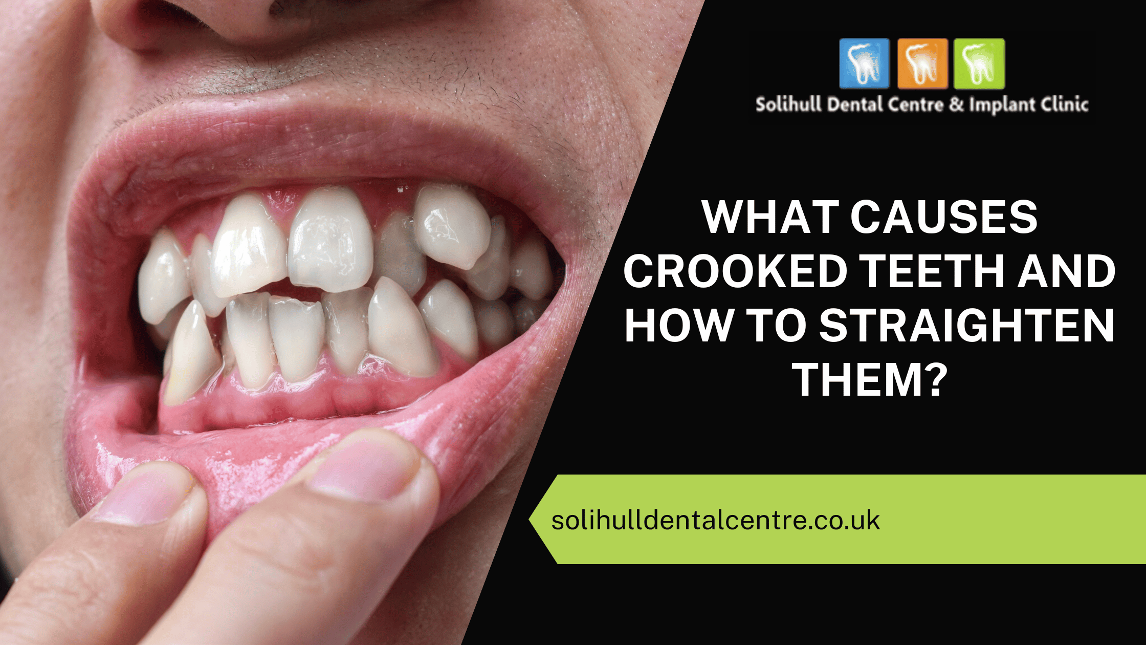 Very Crooked Teeth Wonky Teeth Before And After Photos | Crooked Front