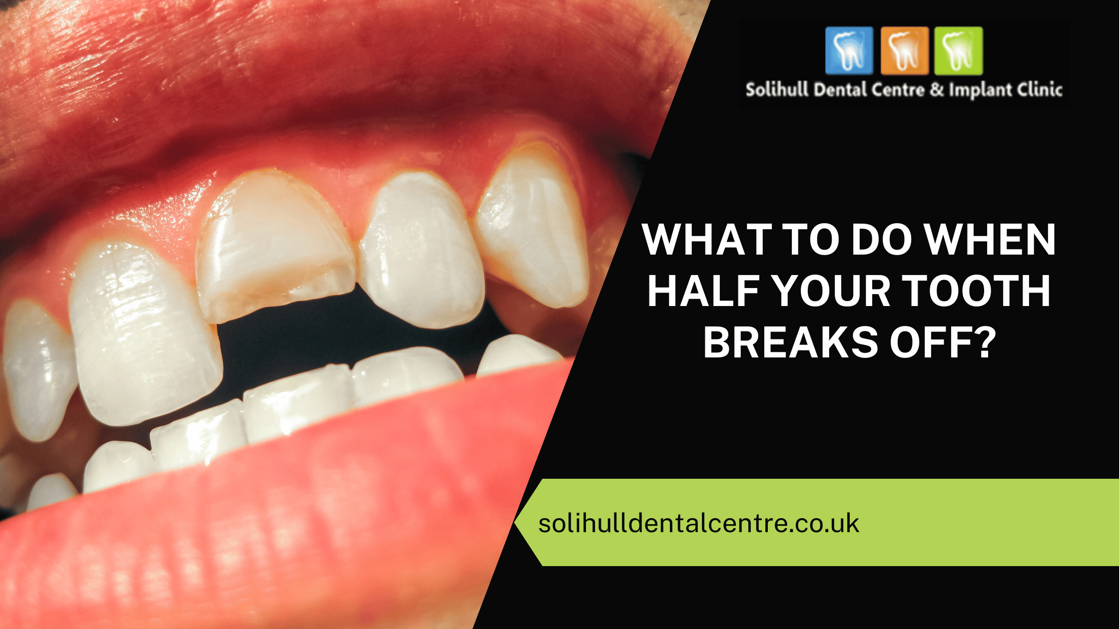 What To Do When Half Your Tooth Breaks Off?